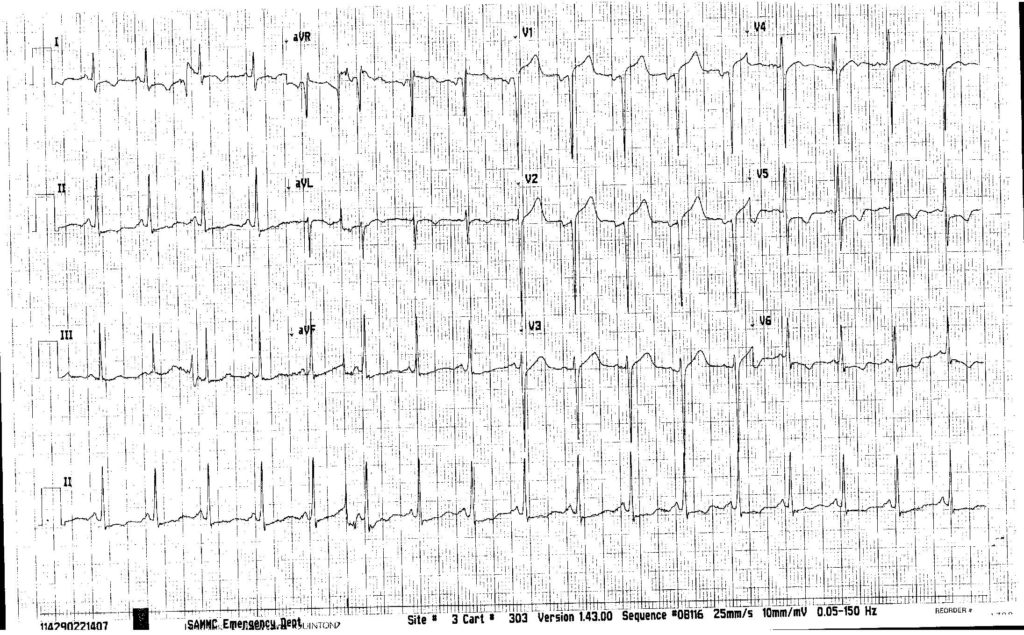 EKG of the Week (AUG 20) – EM Ninja