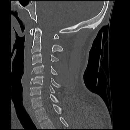 Ortho Case of the Week – C-Spine – EM Ninja