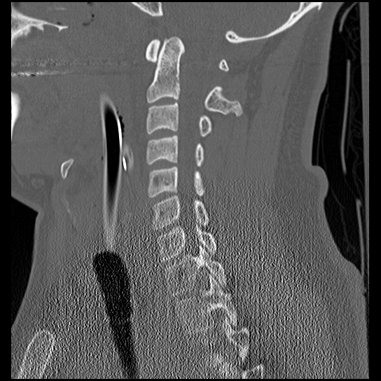 Ortho Case of the Week – C-Spine – EM Ninja