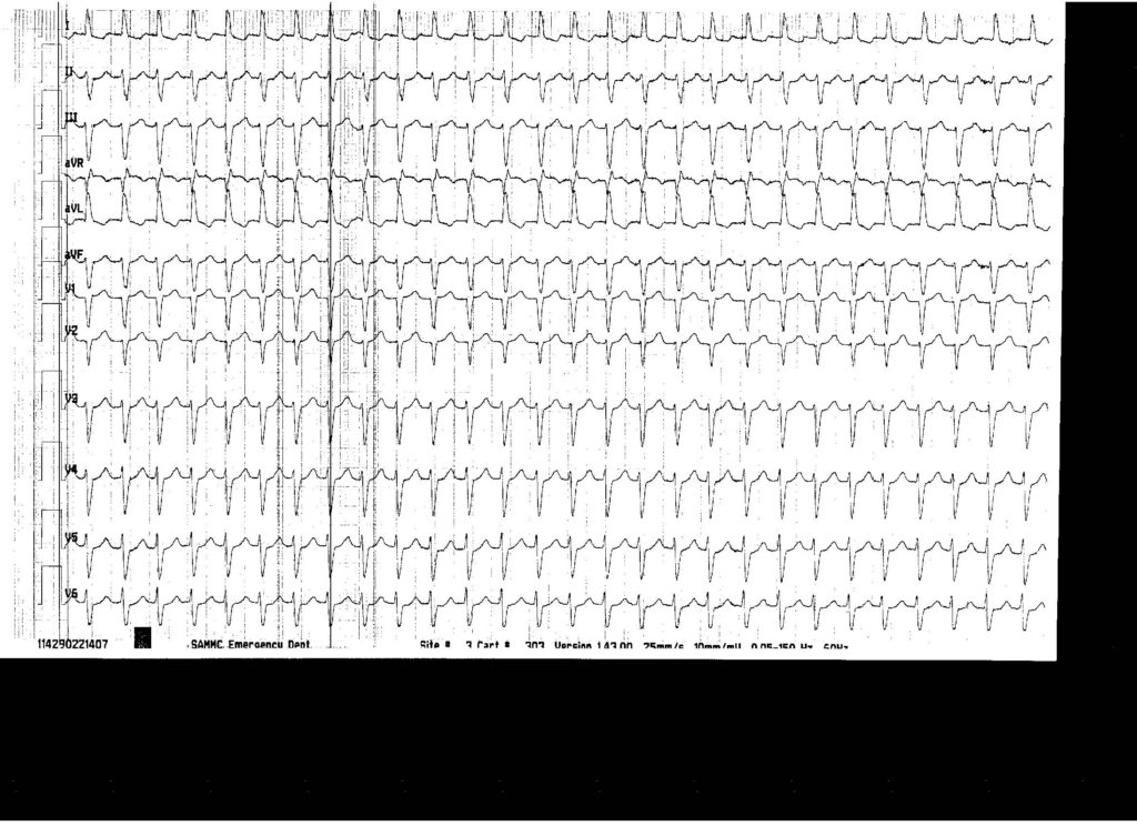 EKG of the Week – EM Ninja