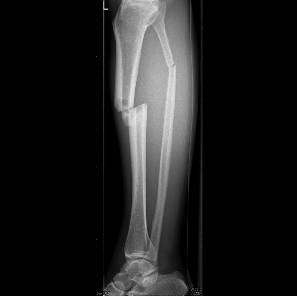 Ortho Case of the Week – Tibia and Fibula – EM Ninja