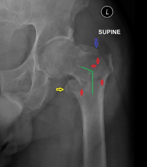 Ortho Case of the Week – Hip and Femur ANSWERS – EM Ninja