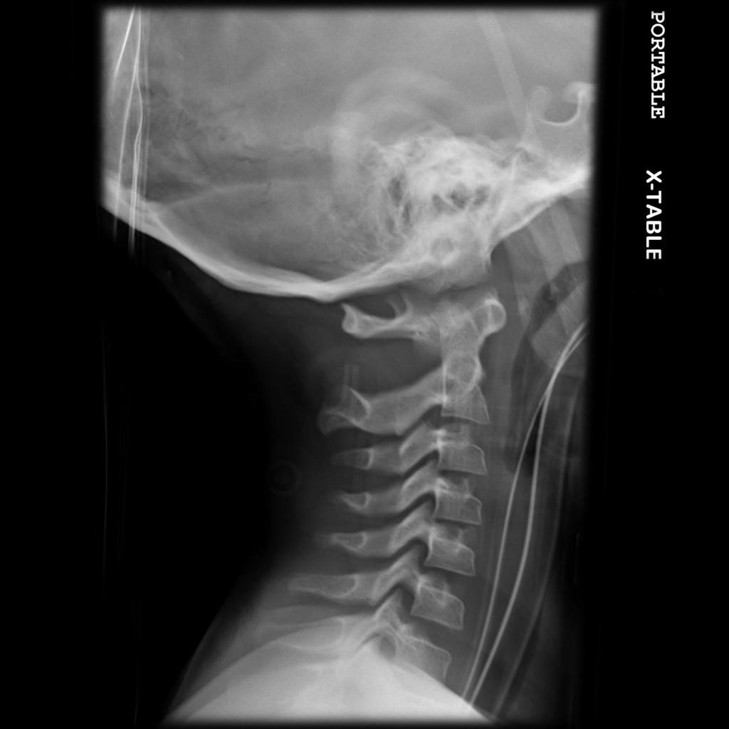 Ortho Case of the Week – C-Spine – EM Ninja