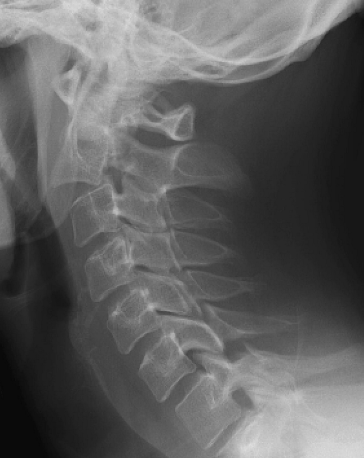 Ortho Case of the Week – C-Spine – EM Ninja