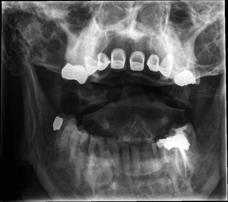 Ortho Case of the Week – C-Spine – EM Ninja