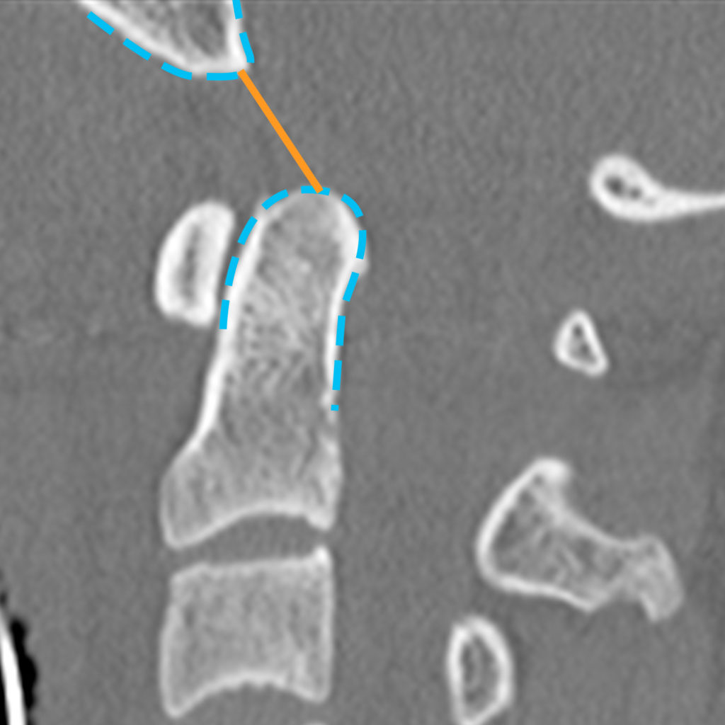 Ortho Case of the Week – C-Spine Answers – EM Ninja