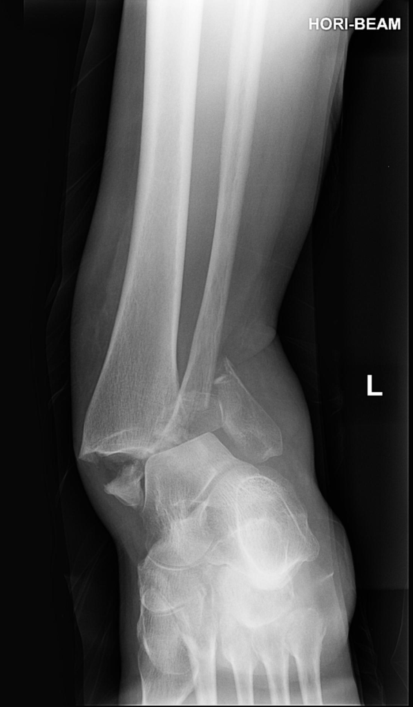 Ortho Case of the Week – Elbow, Ankle, and Jaw Dislocations – EM Ninja